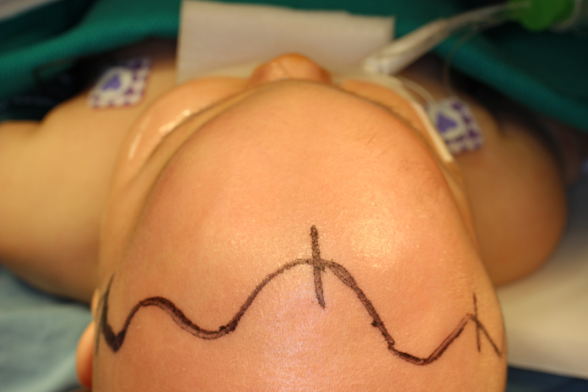 Craniosynostosis Repair | Iowa Head and Neck Protocols - Carver College of Medicine | The ...